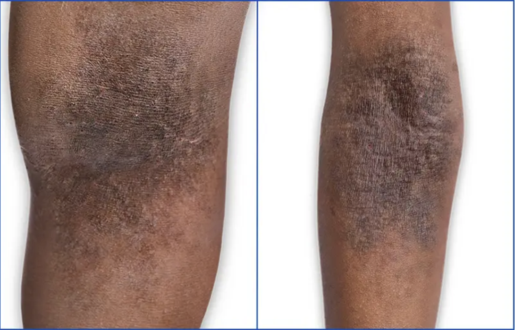 CIBINQO™ (abrocitinib) | About Eczema | Safety Info